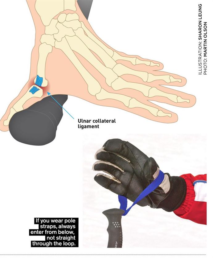 Skier's thumb is from a fall on an outstretched hand holding a ski pole.